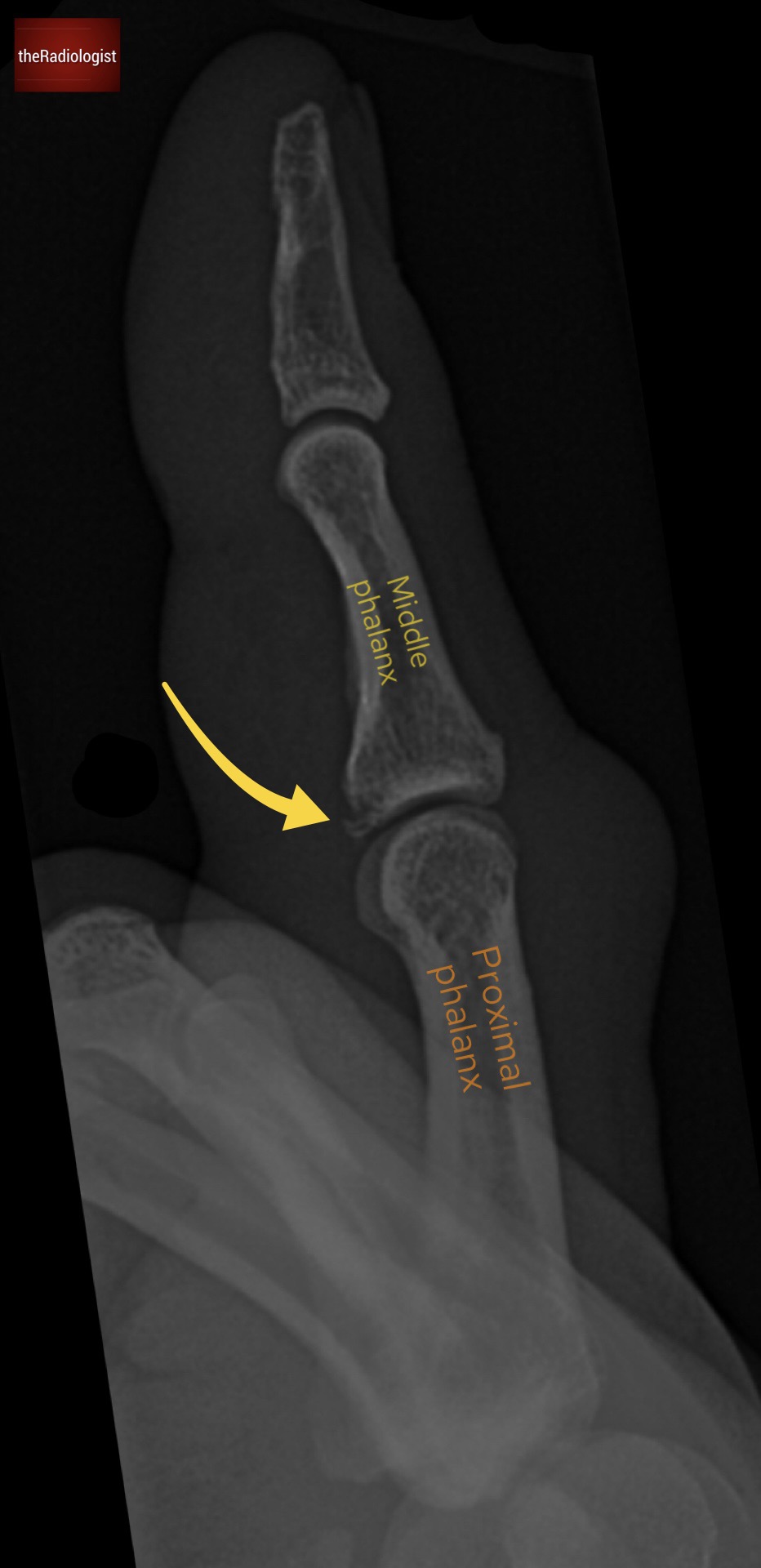 Volar plate injuries – the Radiologist