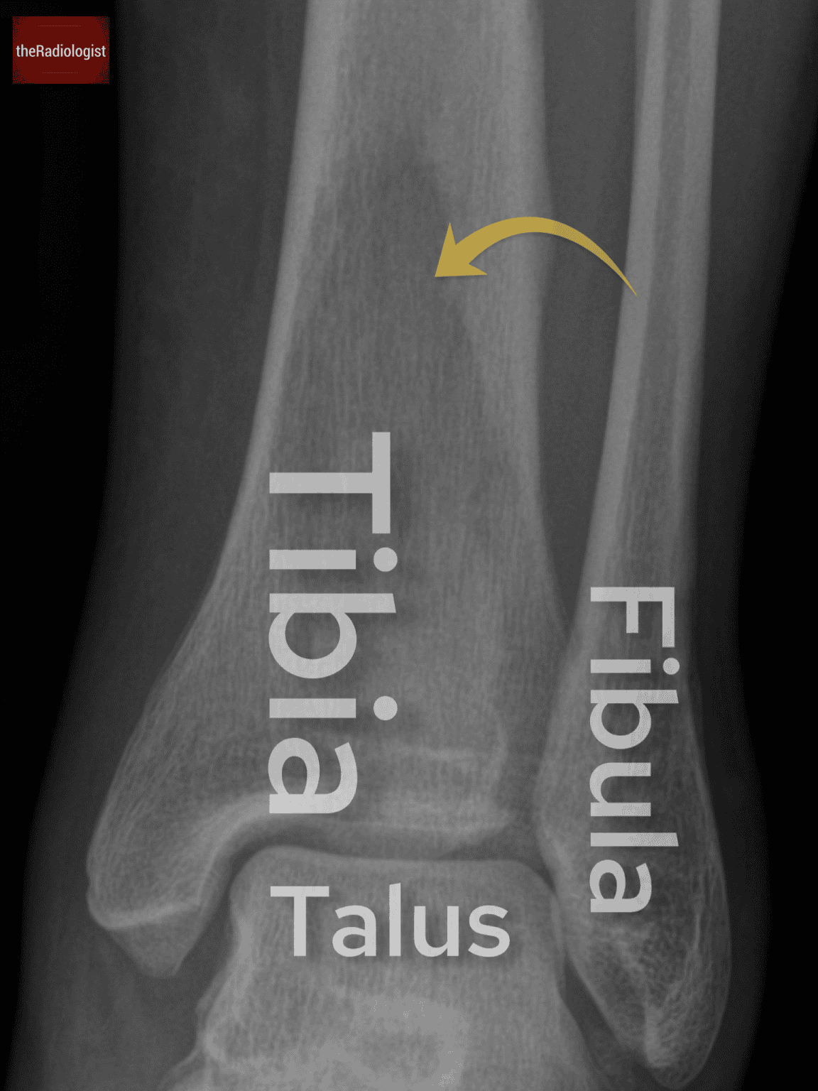 Lytic Bone Metastases | Imaging Features and Causes