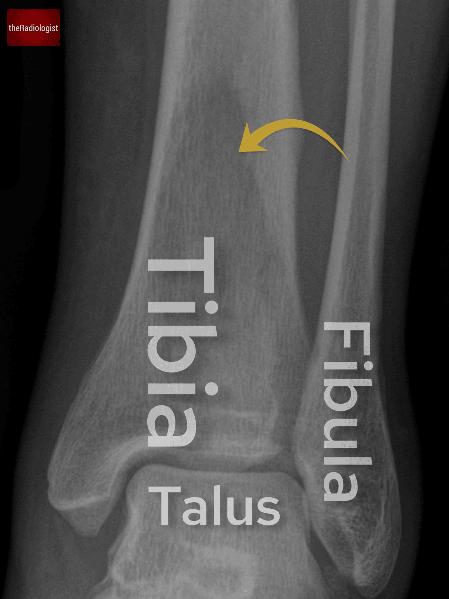 Lytic bone metastases – the Radiologist