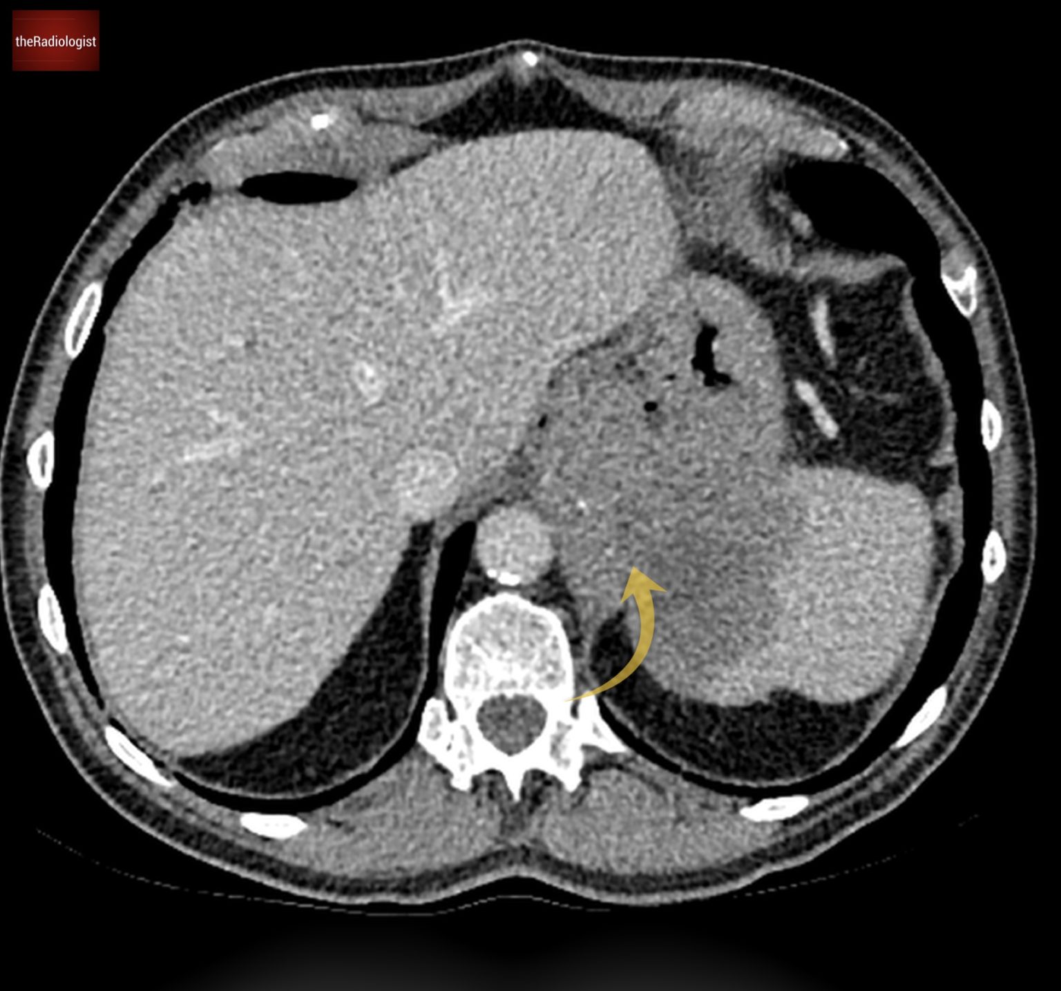 Small Bowel Tumours | CT Imaging Guide