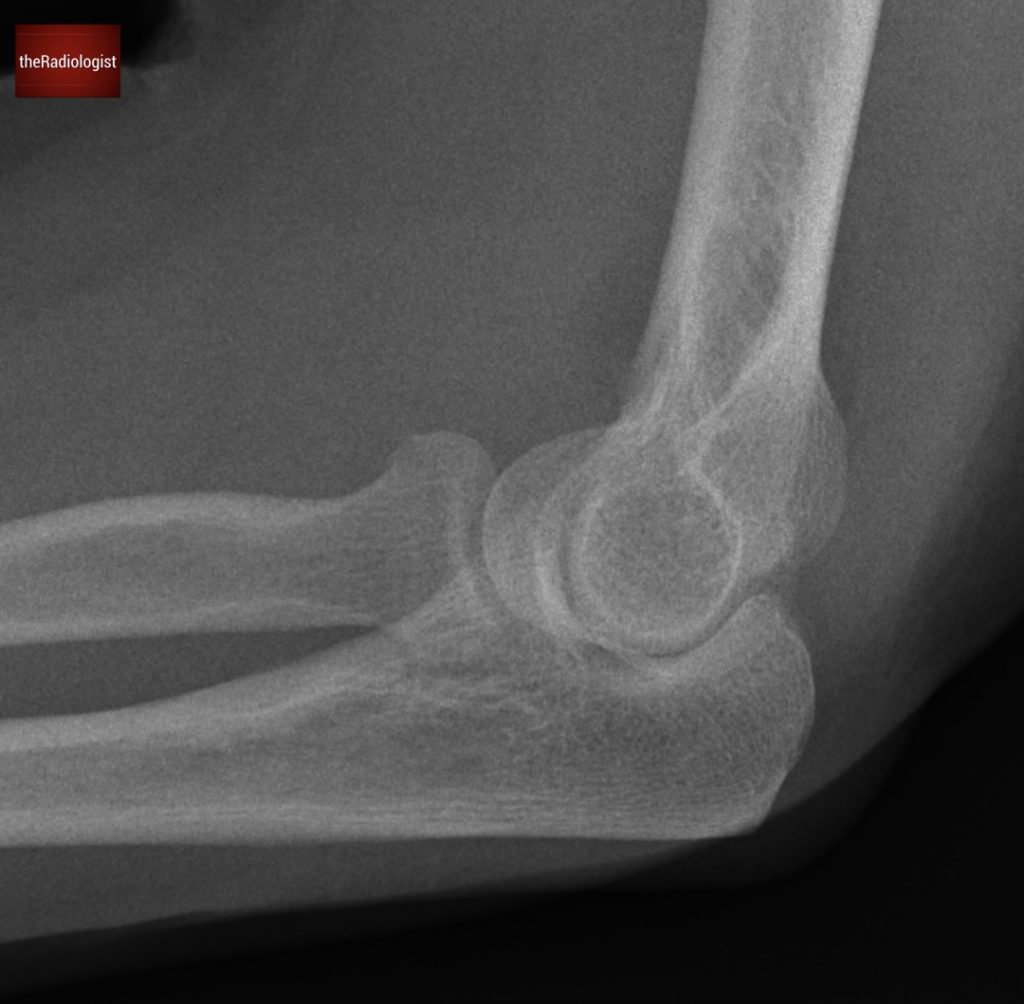 Elbow fat pads - the Radiologist