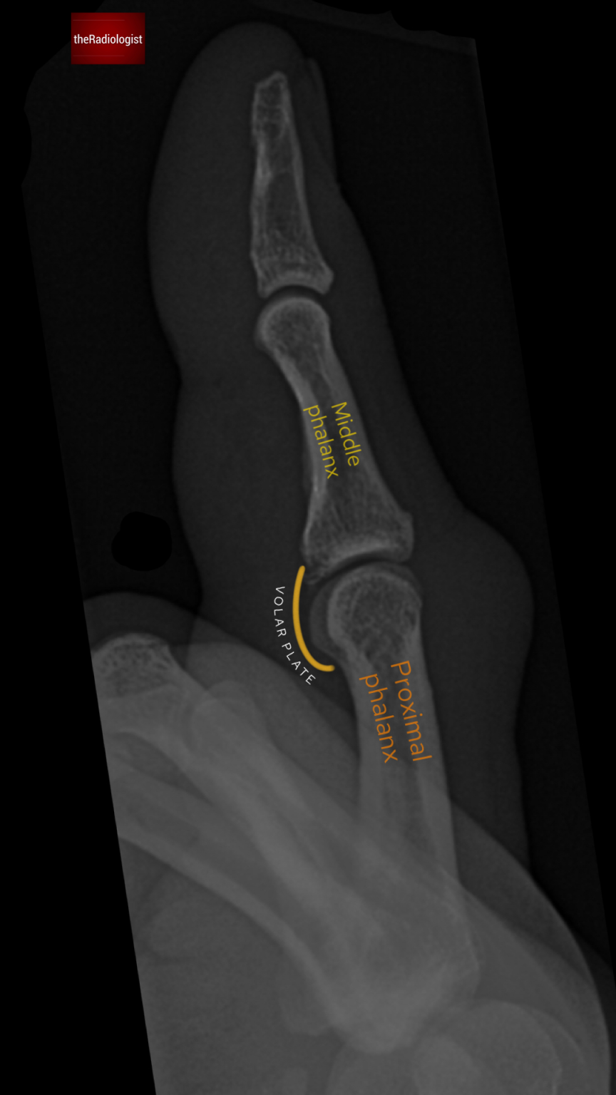 Volar plate injuries – the Radiologist