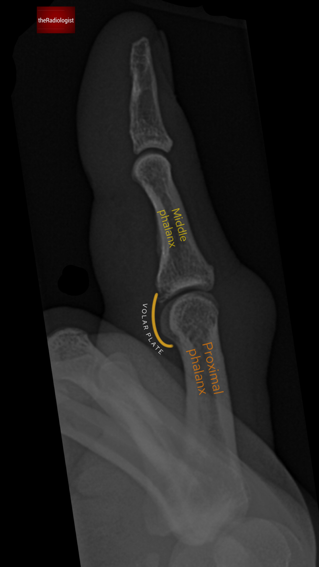 Volar plate injuries – the Radiologist