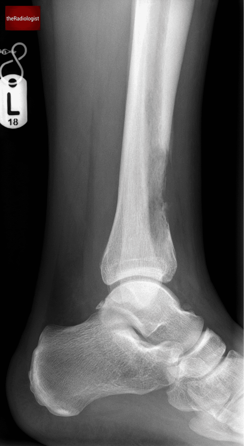 Lytic Bone Metastases | Imaging Features and Causes