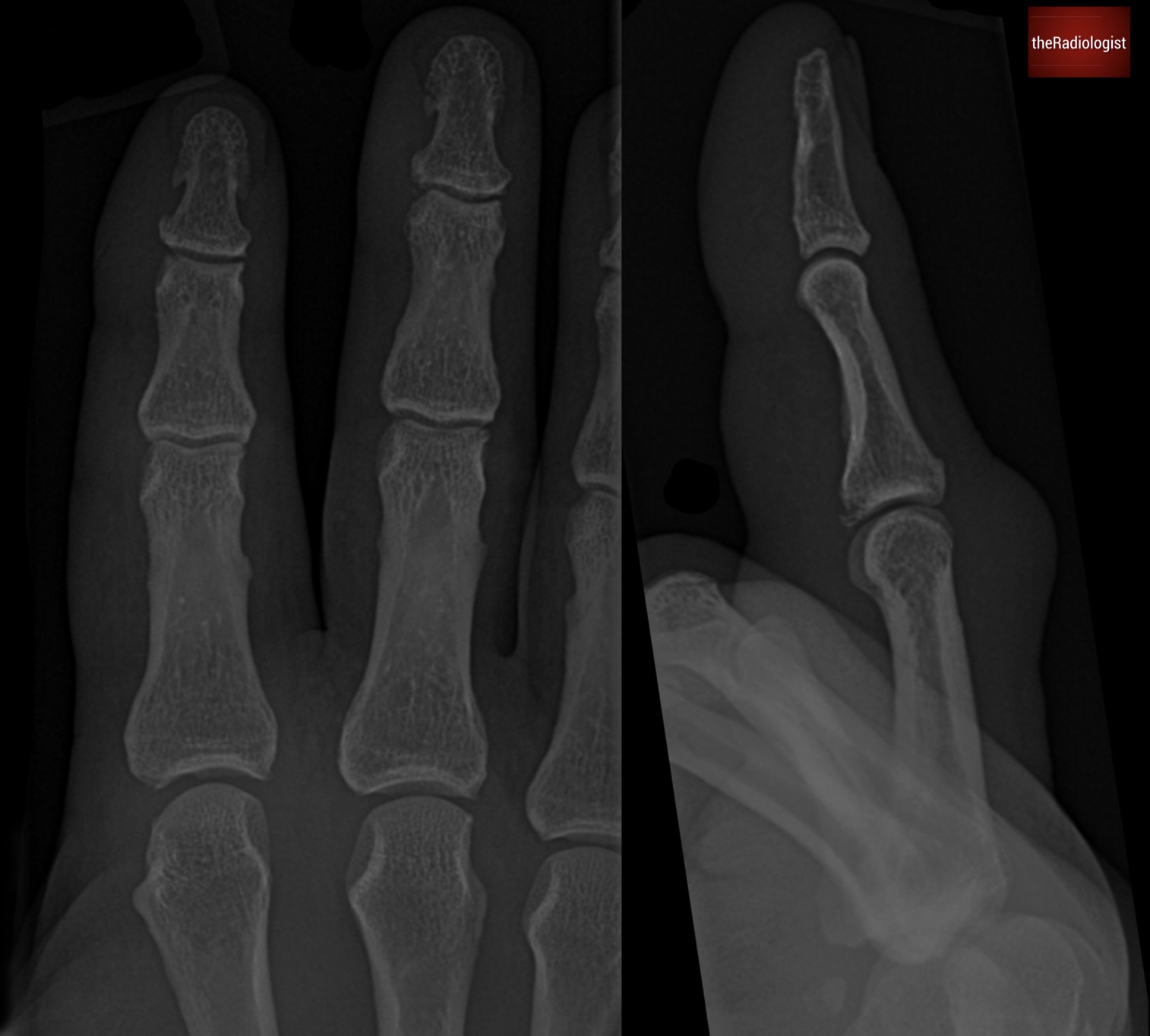 Volar plate injuries – the Radiologist