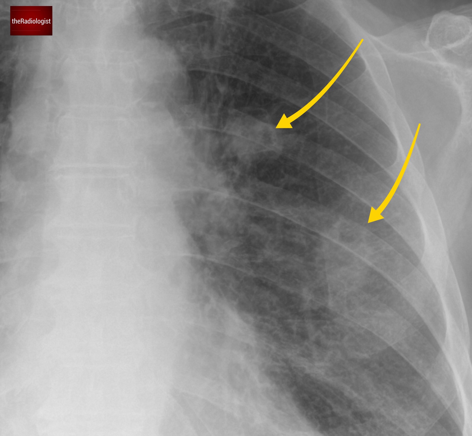 Multiple cavitating lesions – the Radiologist