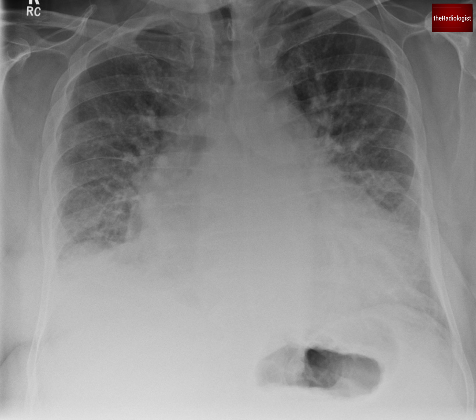 Pulmonary oedema – the Radiologist