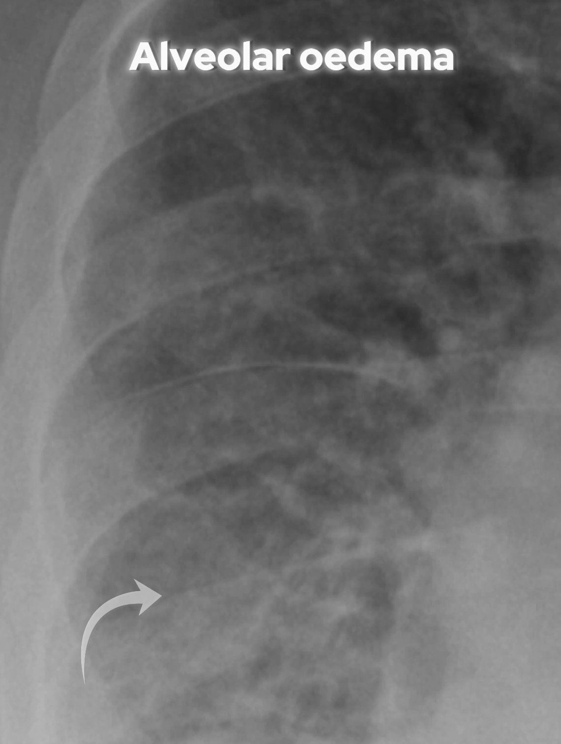 Pulmonary Edema X-Ray | CXR Findings and Key Signs