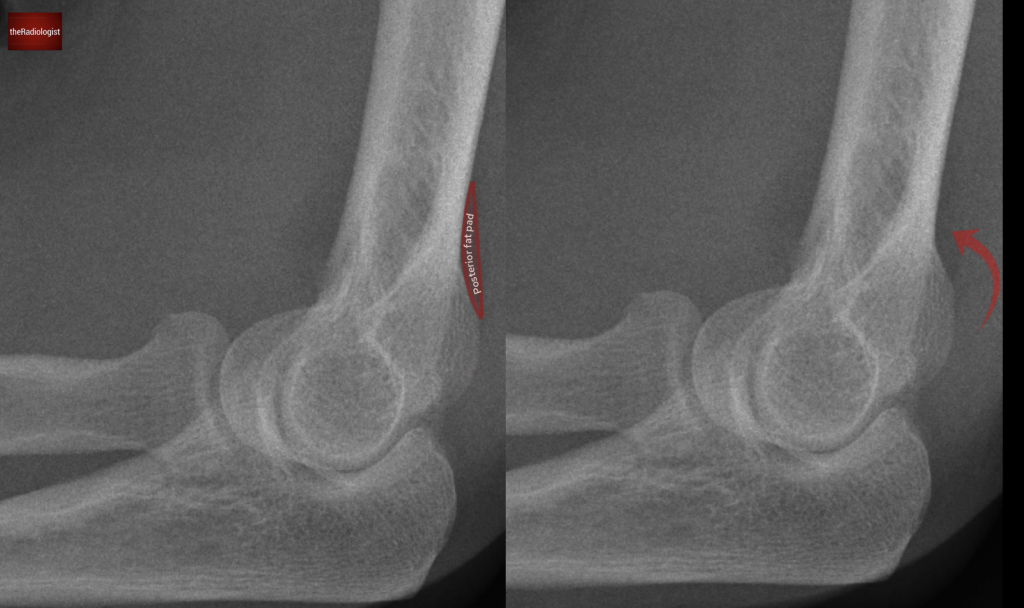 Elbow fat pads - the Radiologist