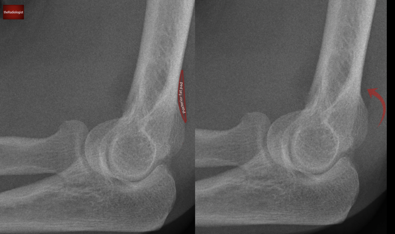 Elbow fat pads - the Radiologist