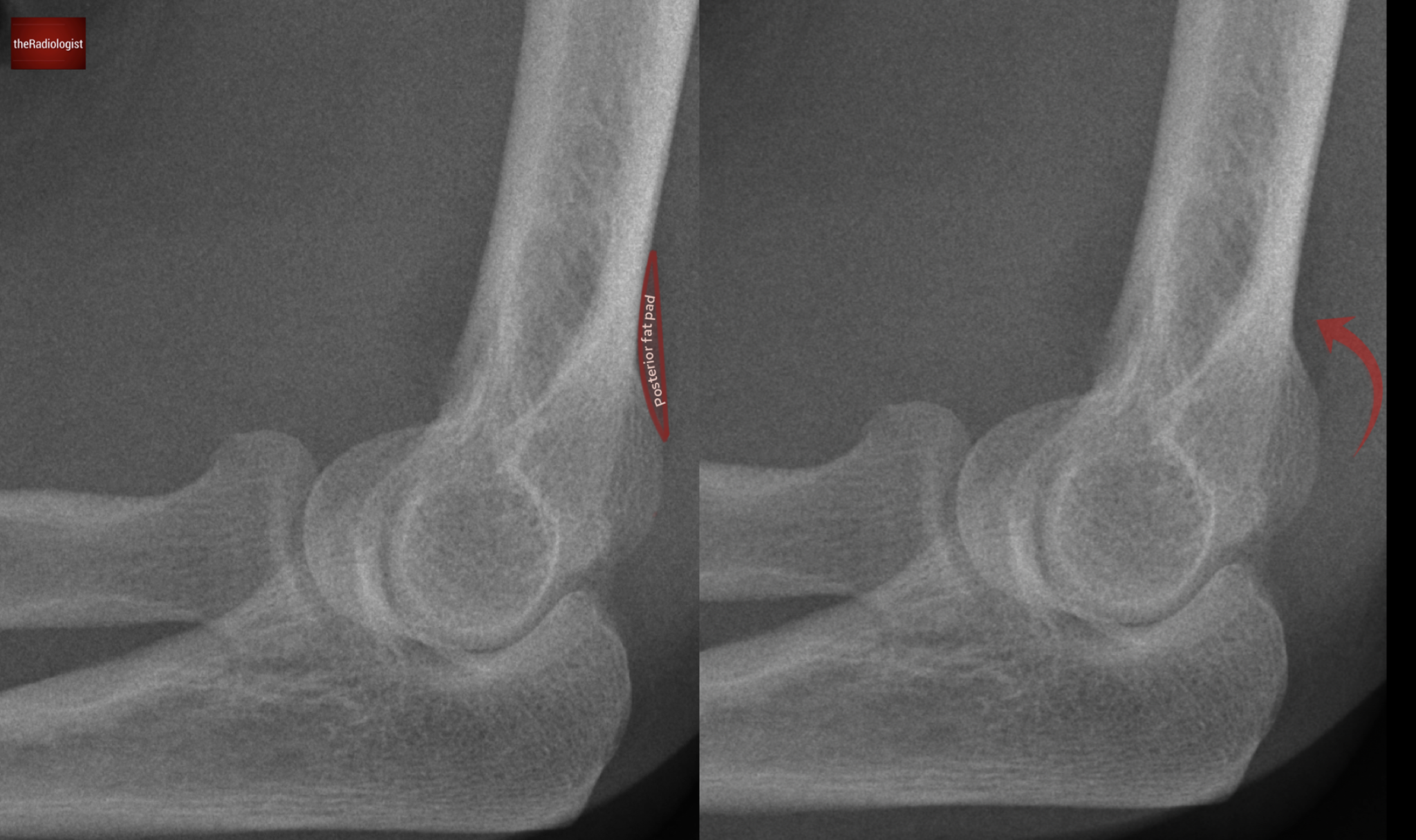 Elbow fat pads – the Radiologist