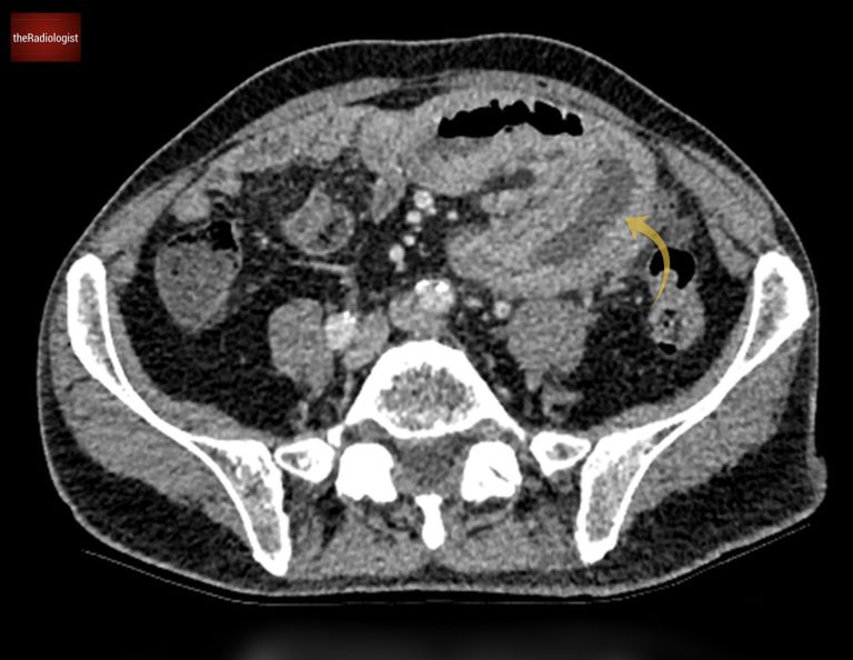 Small bowel tumours – the Radiologist
