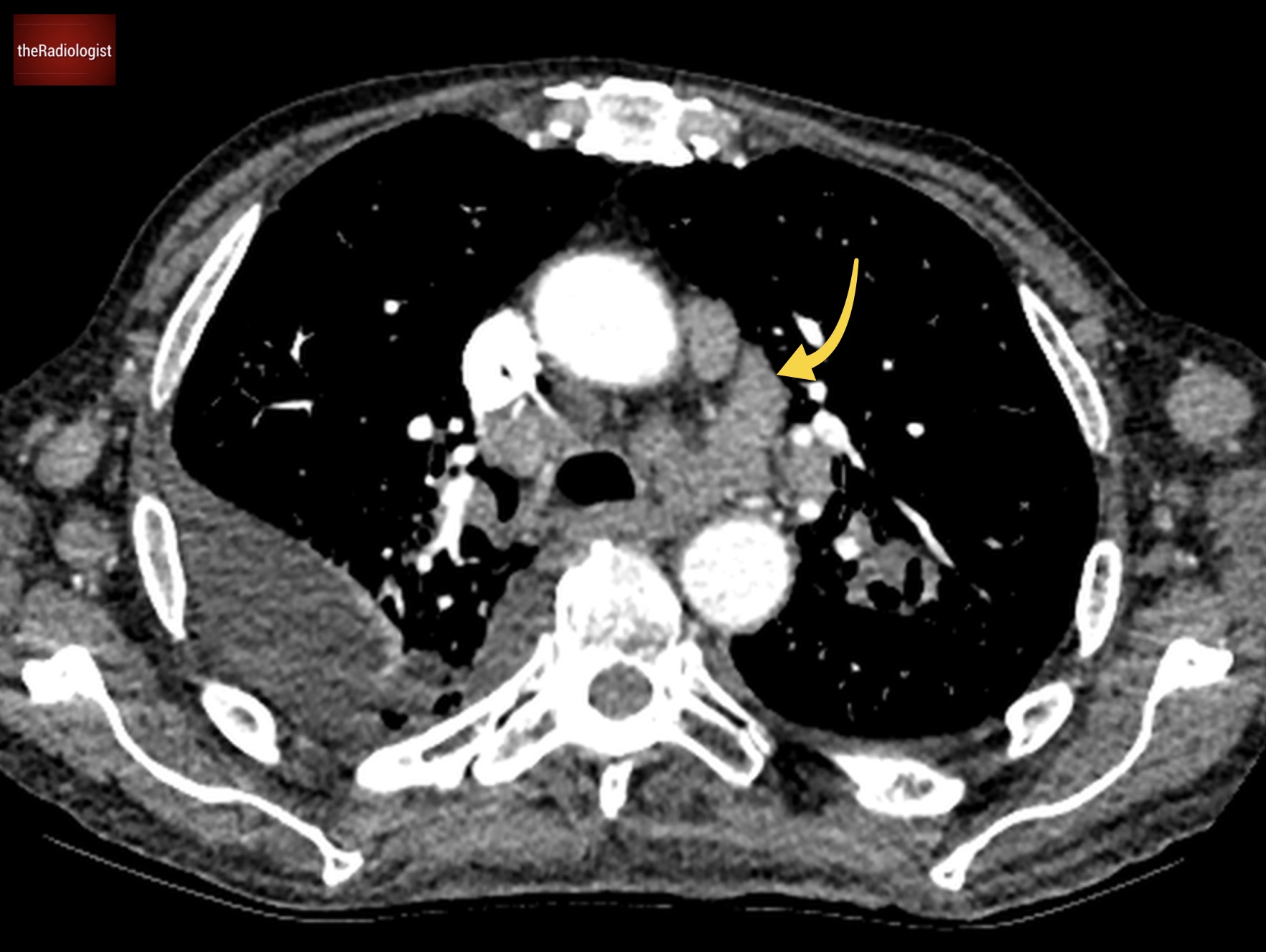 Multiple cavitating lesions – the Radiologist