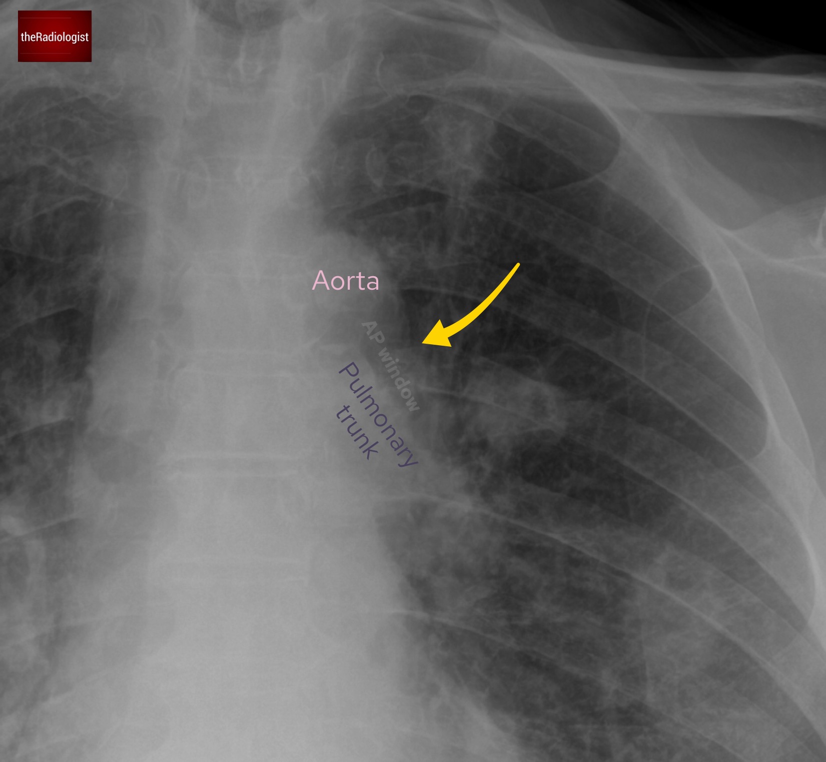Cavitating Lesions | Chest X-ray and CT Differential