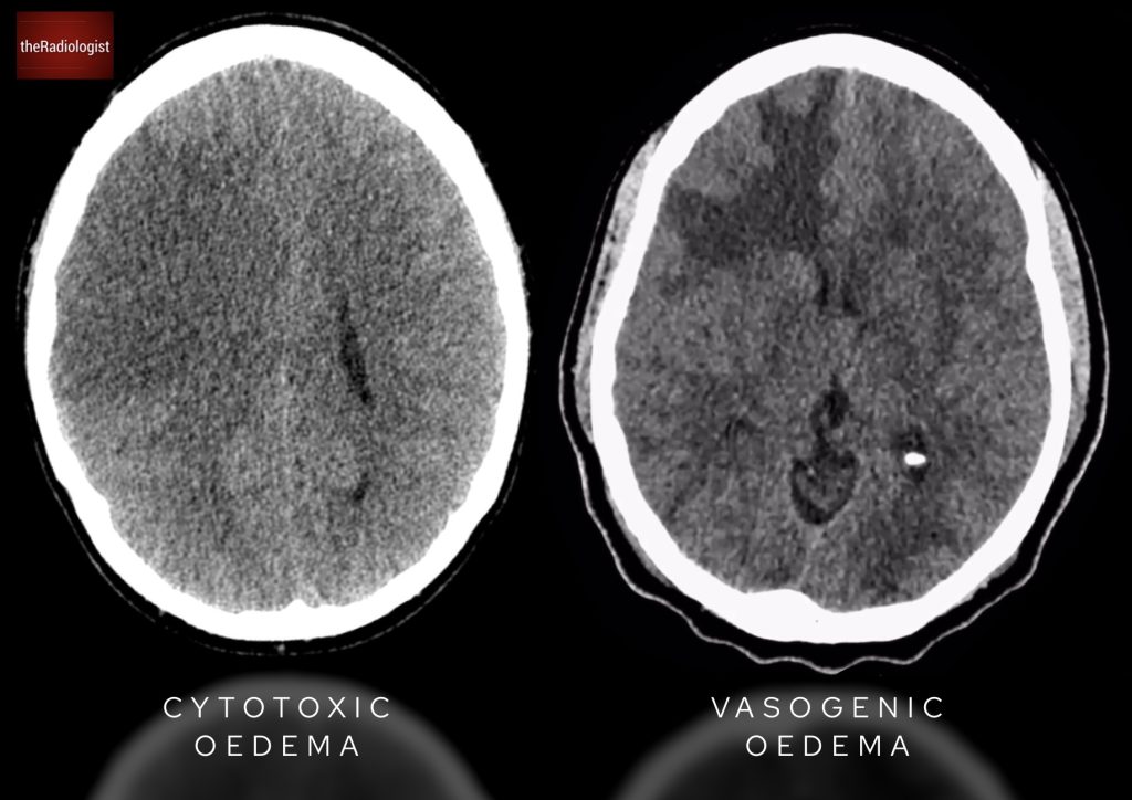 Space Occupying Lesion | CT and MRI Brain Imaging