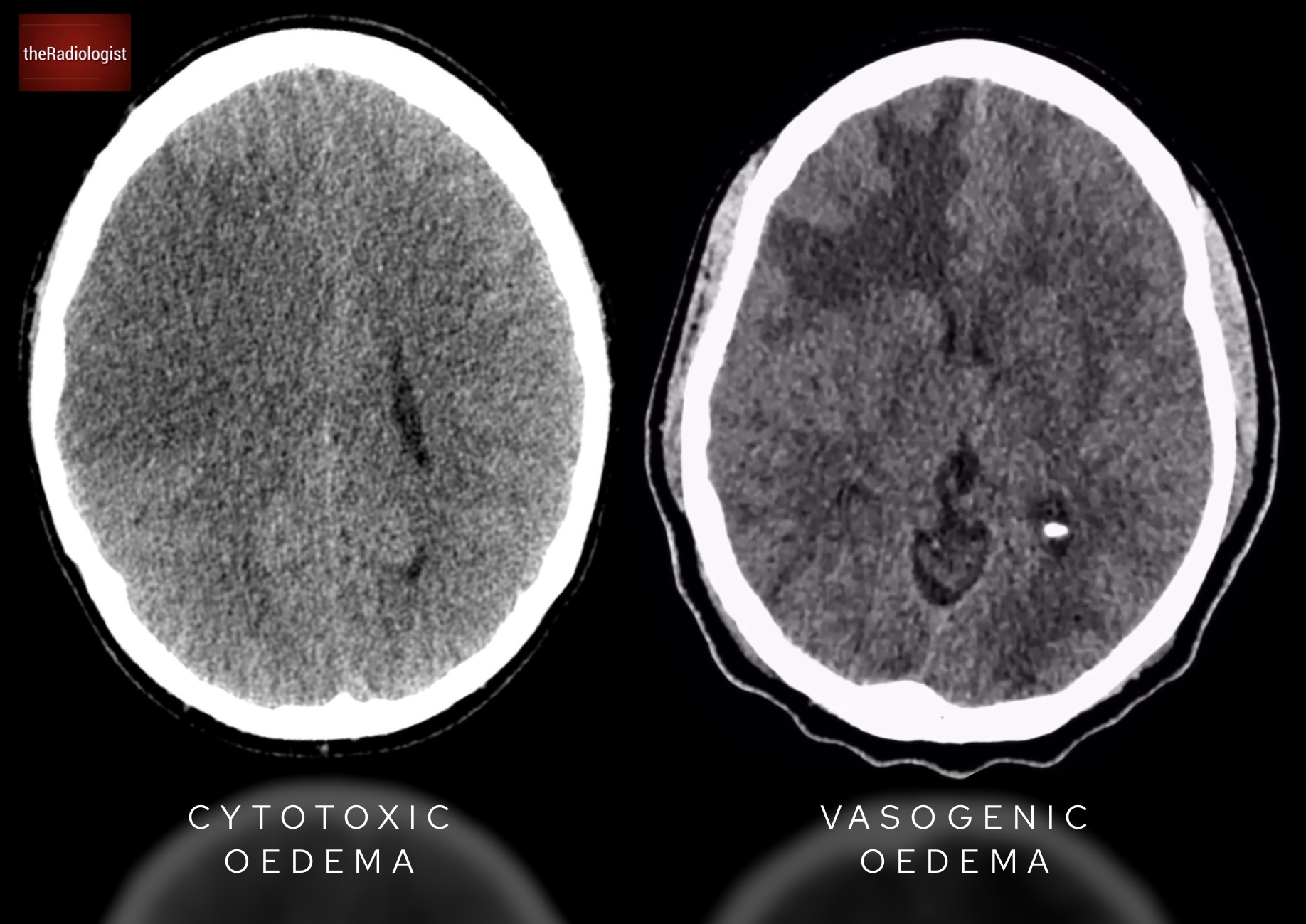Space occupying lesions – the Radiologist