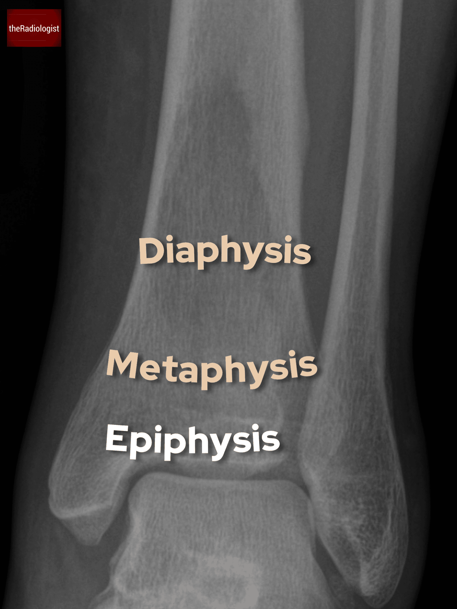 Lytic Bone Metastases | Imaging Features and Causes