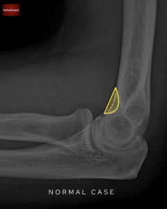 Elbow fat pads – the Radiologist