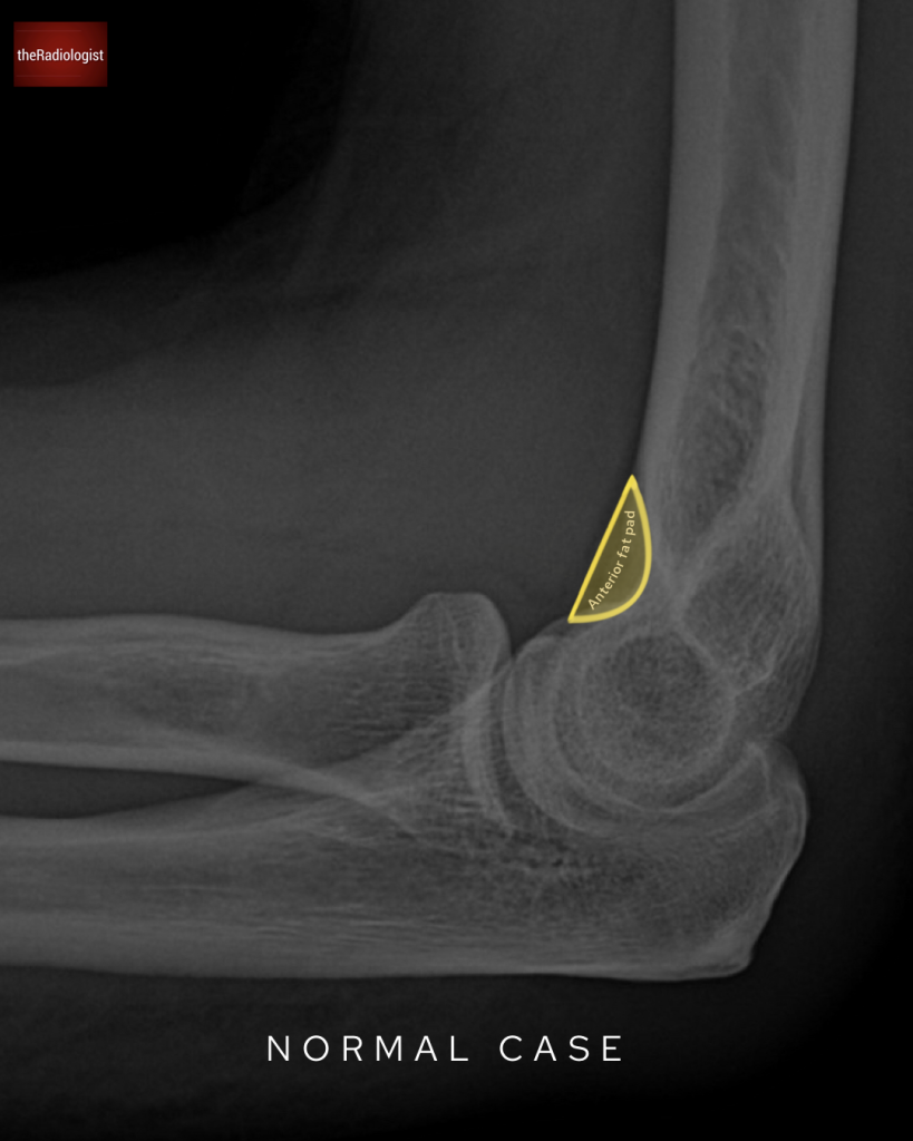 Elbow fat pads – the Radiologist