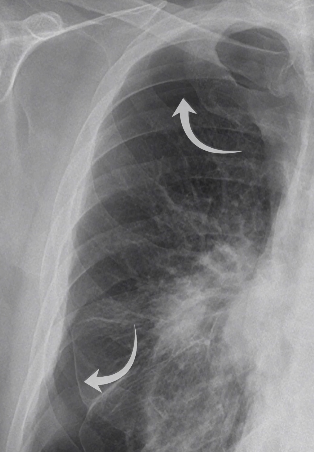 Pneumothorax - the Radiologist