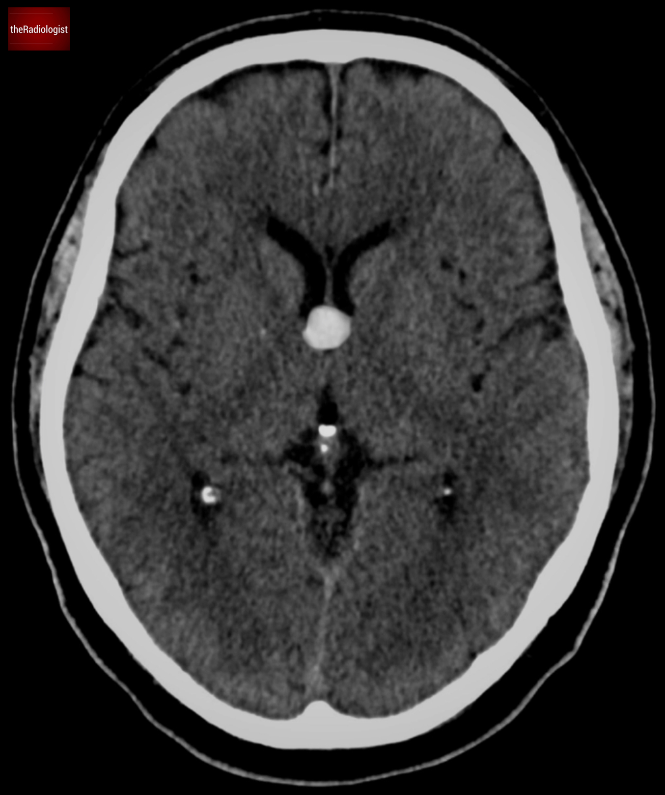 Colloid cyst – the Radiologist