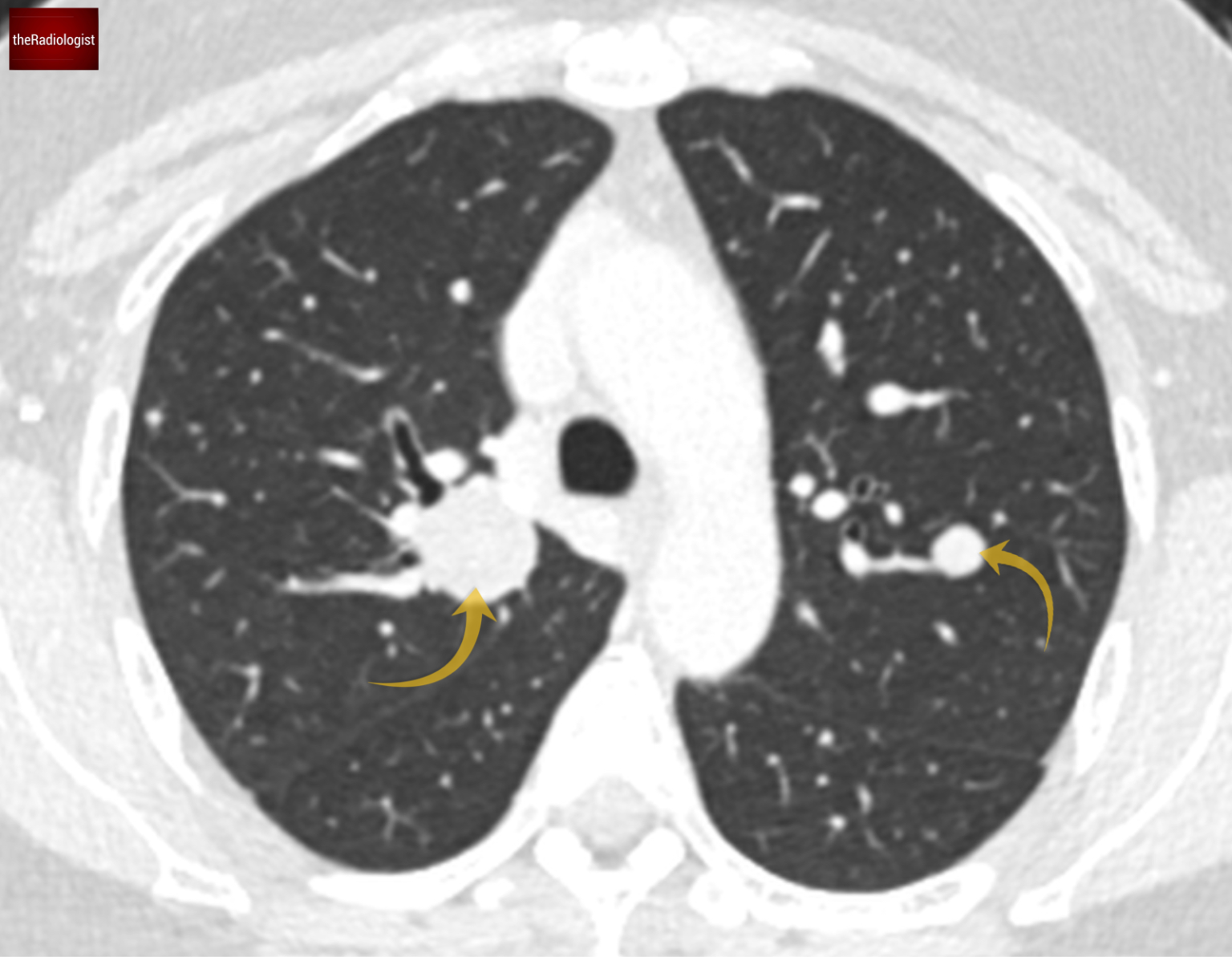 Multiple lung nodules – the Radiologist