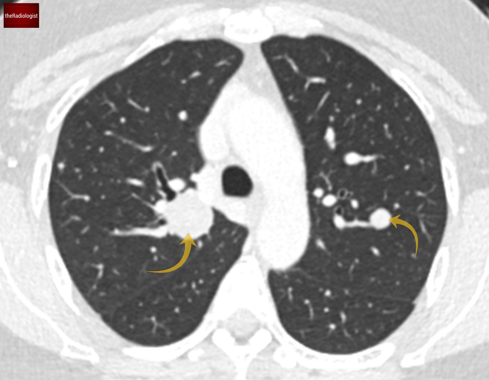 Multiple lung nodules – the Radiologist