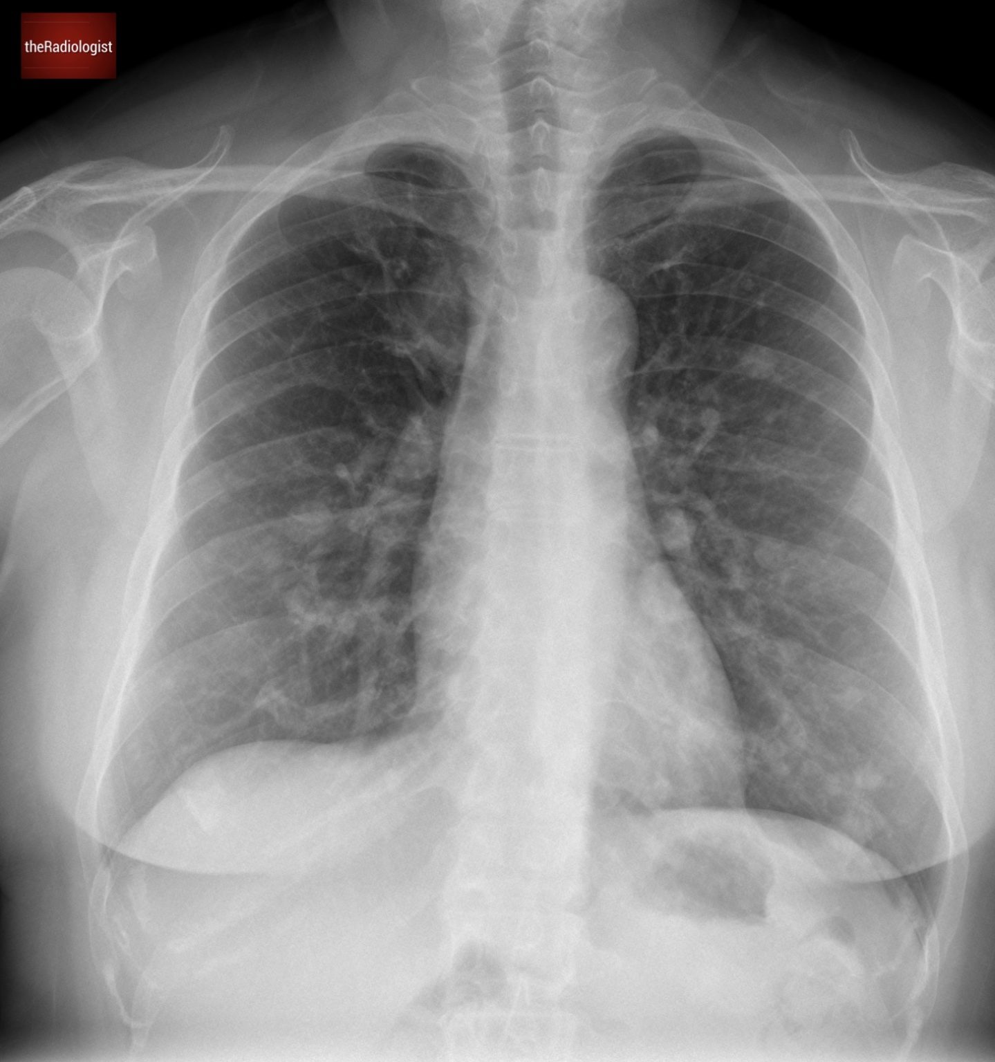 Multiple Lung Nodules | Chest X-ray and CT Guide