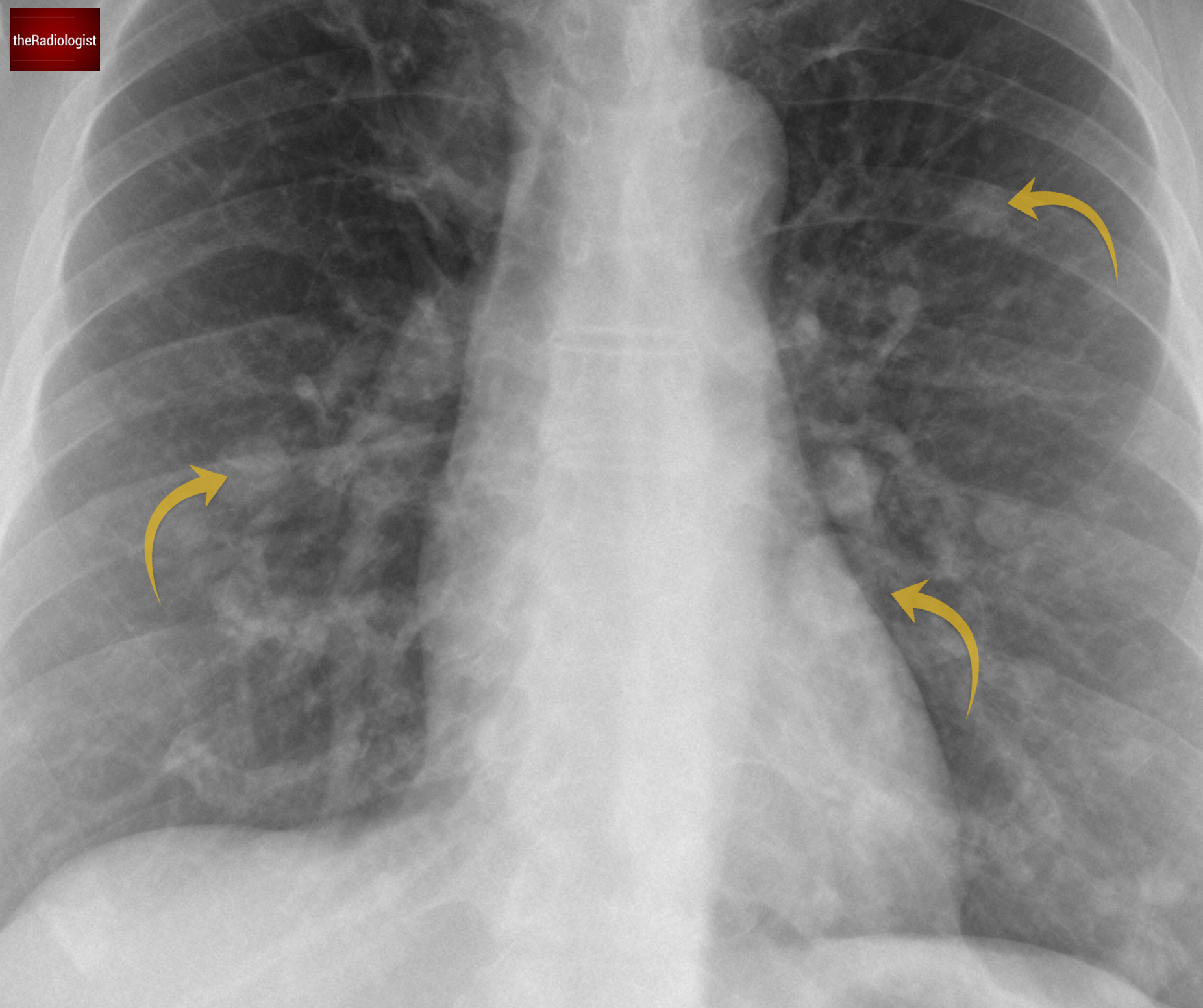 Multiple Lung Nodules | Chest X-ray and CT Guide