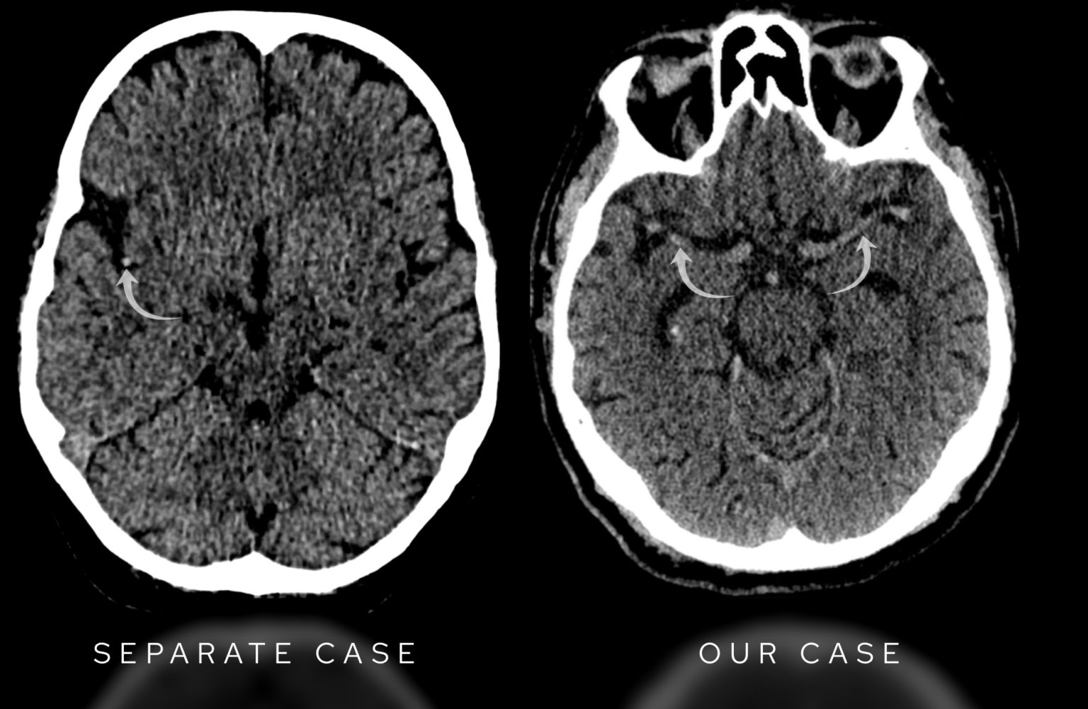 Early MCA territory infarcts - the Radiologist