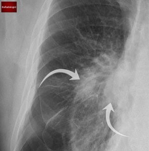 Pneumothorax - the Radiologist