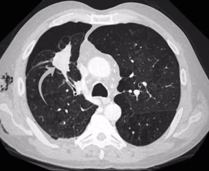 Pneumothorax - the Radiologist