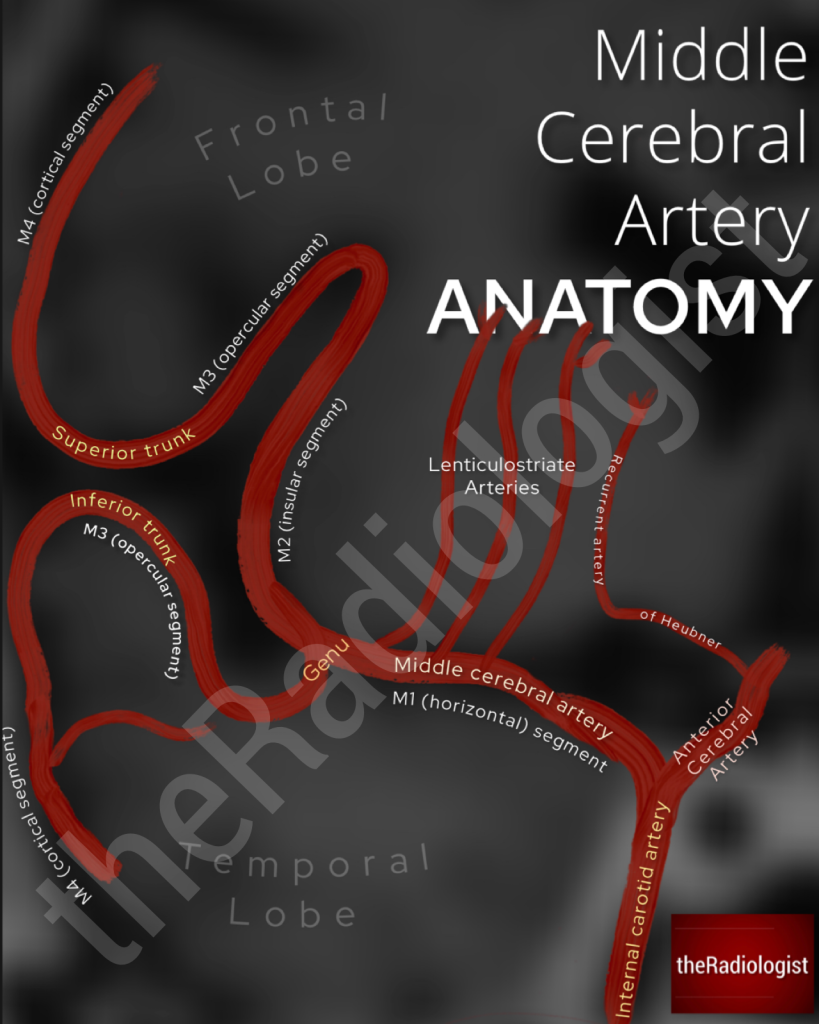 Early MCA territory infarcts – the Radiologist