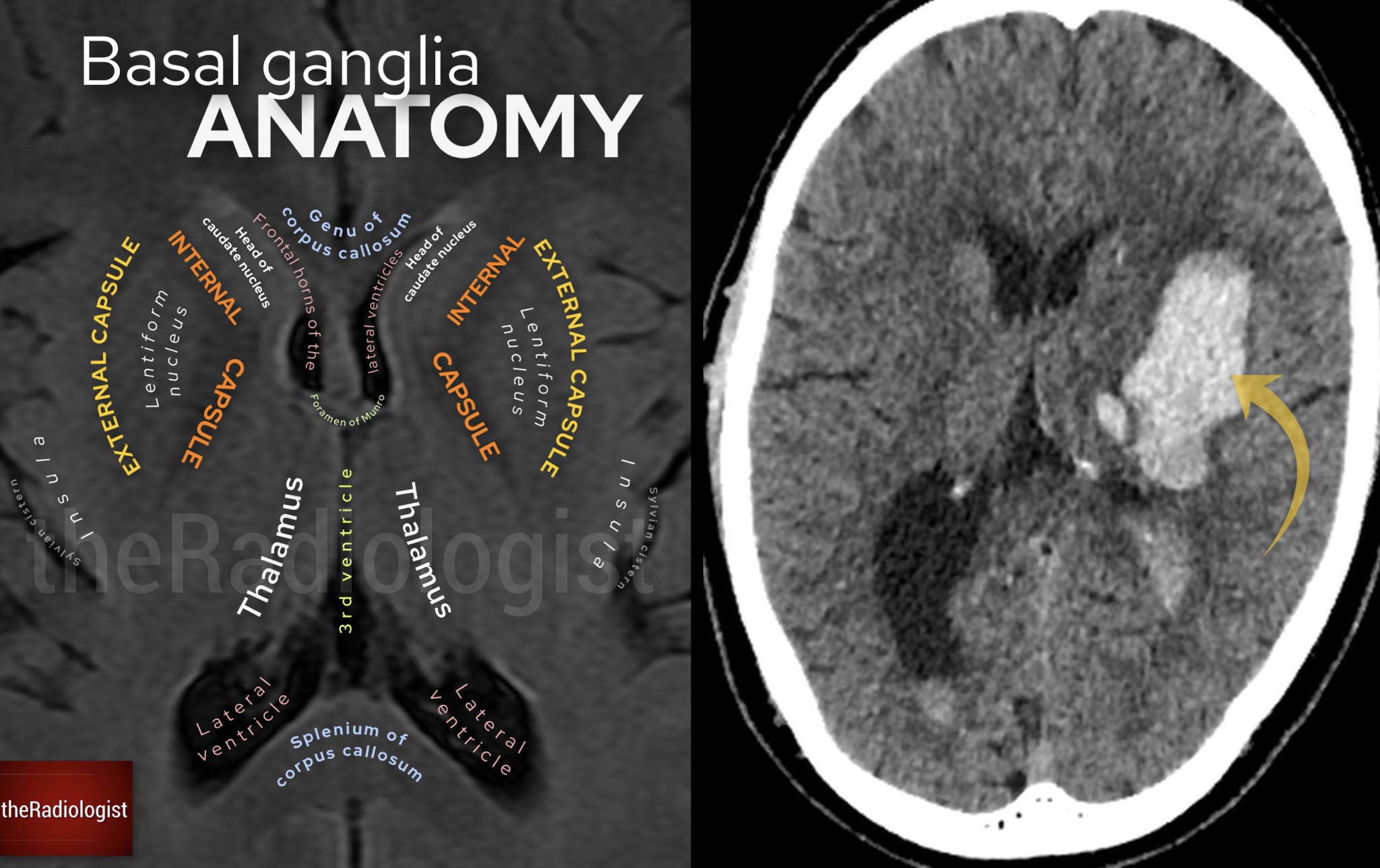 Basal Ganglia Haemorrhage The Radiologist