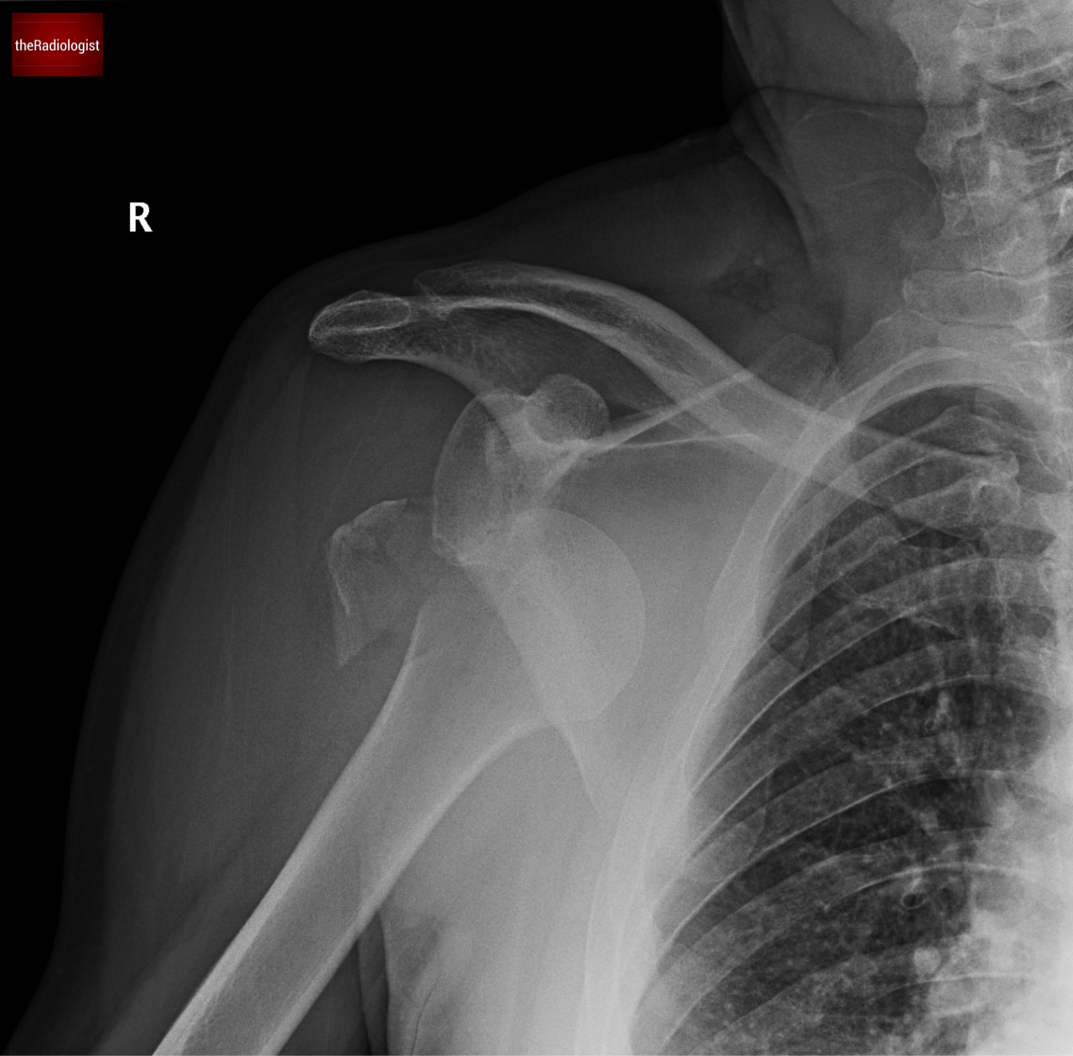 Shoulder dislocation – the Radiologist