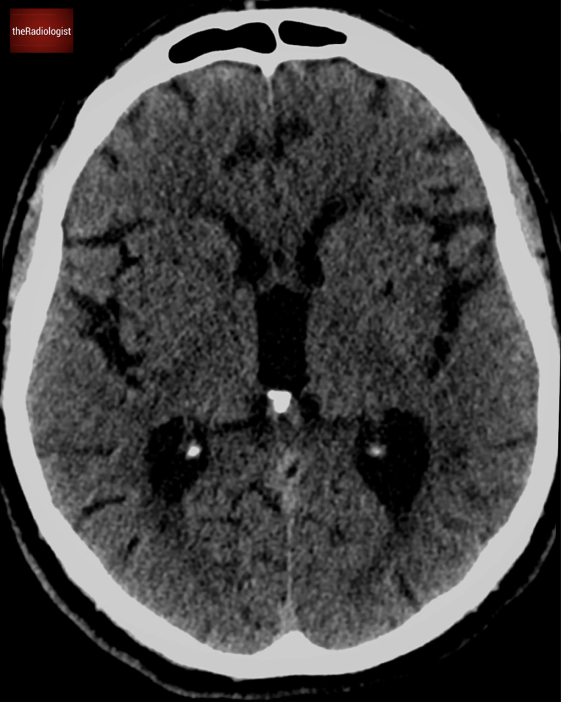 Early MCA territory infarcts – the Radiologist