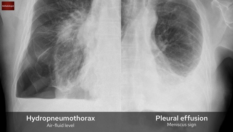 Pneumothorax – the Radiologist