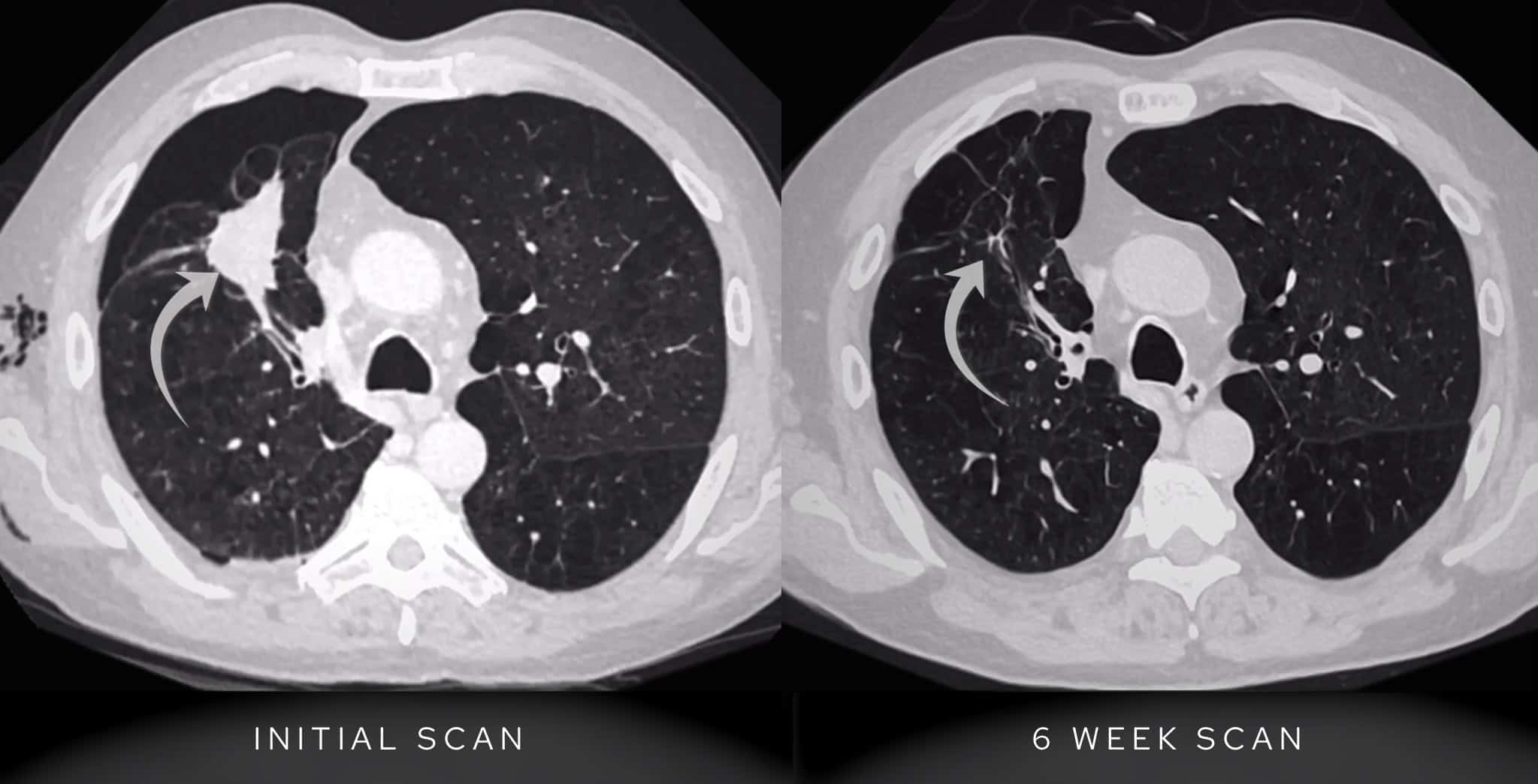 Solitary pulmonary nodule – the Radiologist