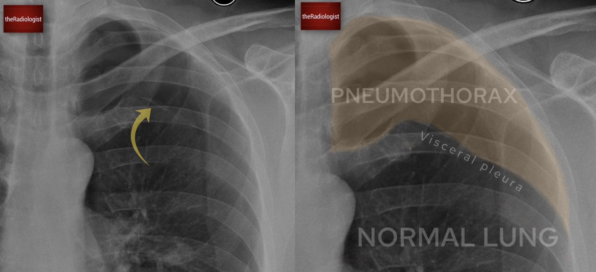 Pneumothorax – the Radiologist