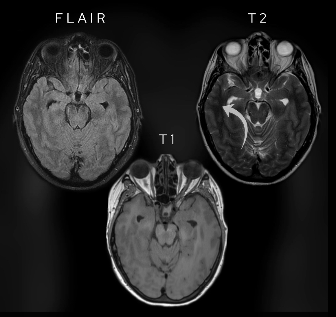 Colloid cyst – the Radiologist