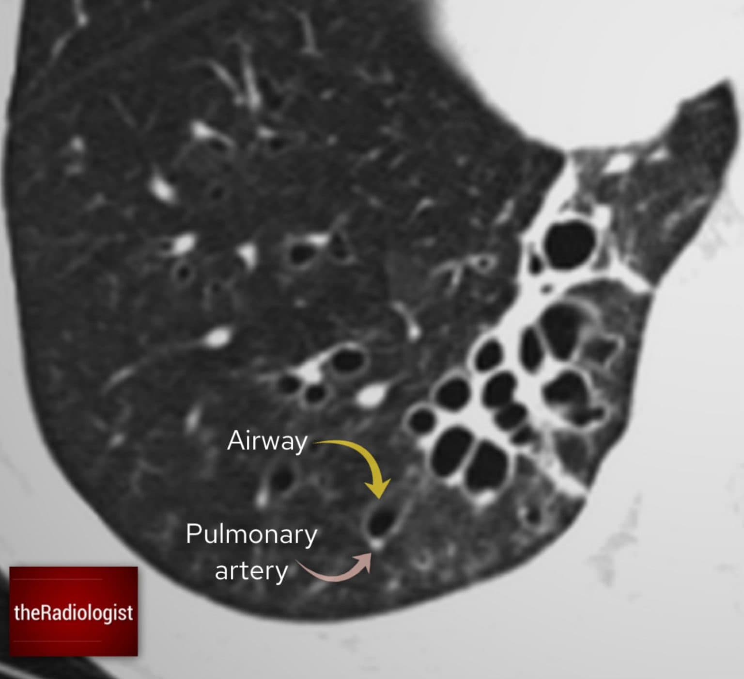 Bronchiectasis X-ray Signs | Ring Shadows & Tram Tracks
