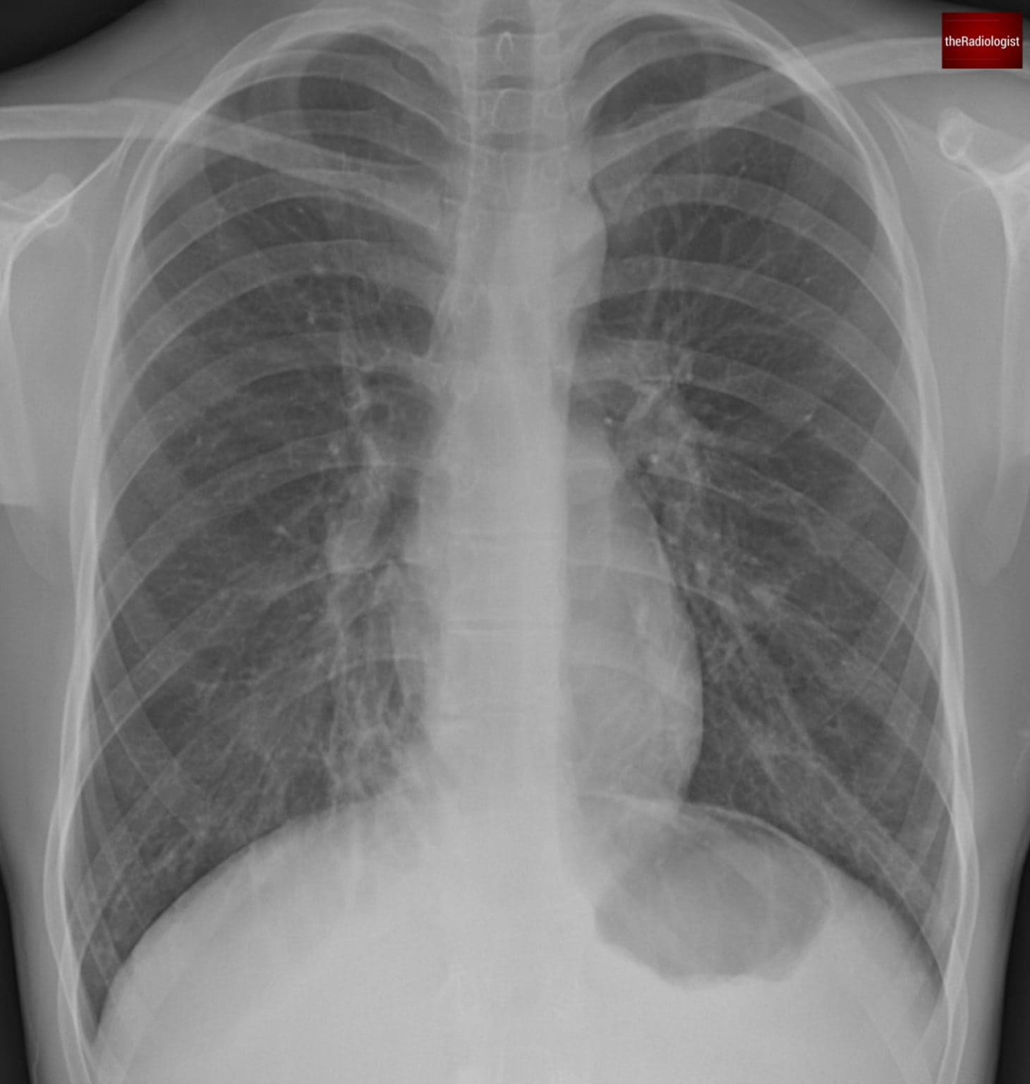 Bronchiectasis X-ray Signs | Ring Shadows & Tram Tracks