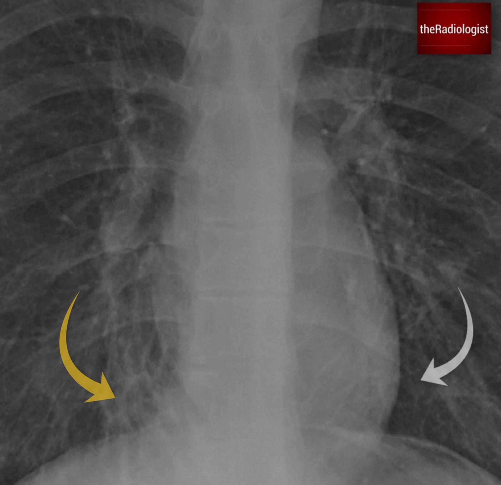 Bronchiectasis – the Radiologist