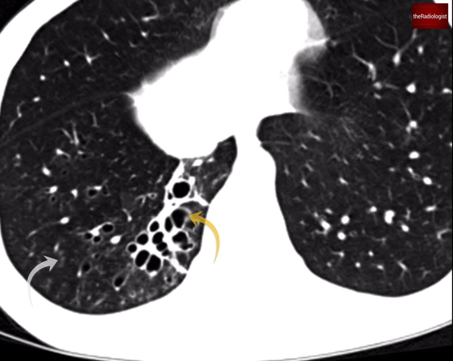 Bronchiectasis – the Radiologist