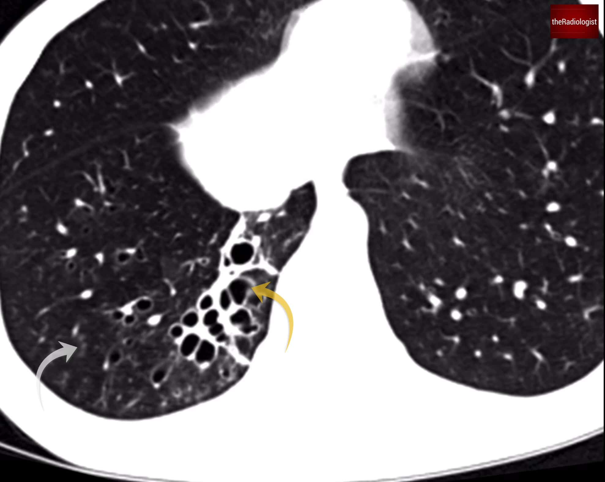 Bronchiectasis – the Radiologist