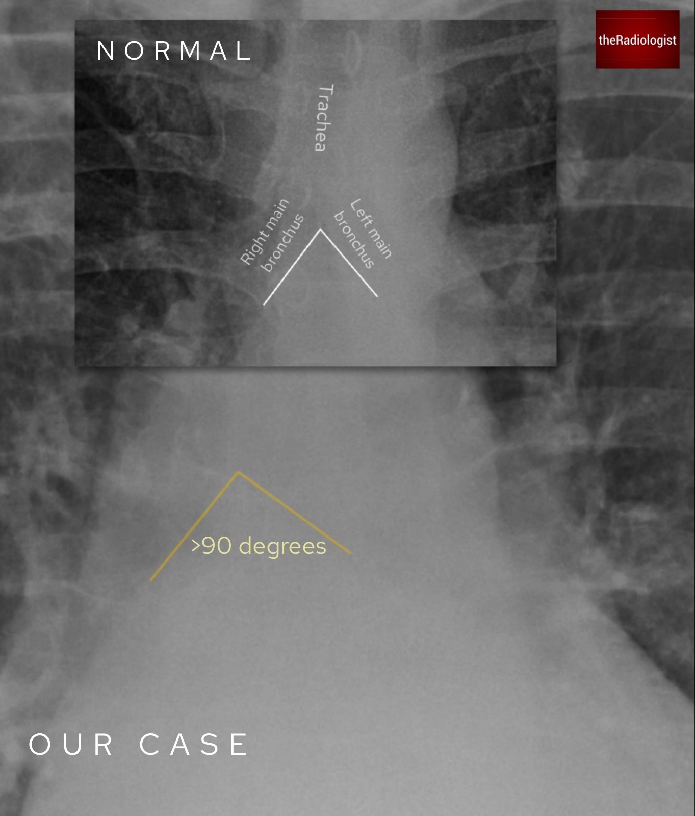 Solitary pulmonary nodule – the Radiologist