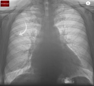 How to Read a Chest X-ray | CXR Interpretation Guide