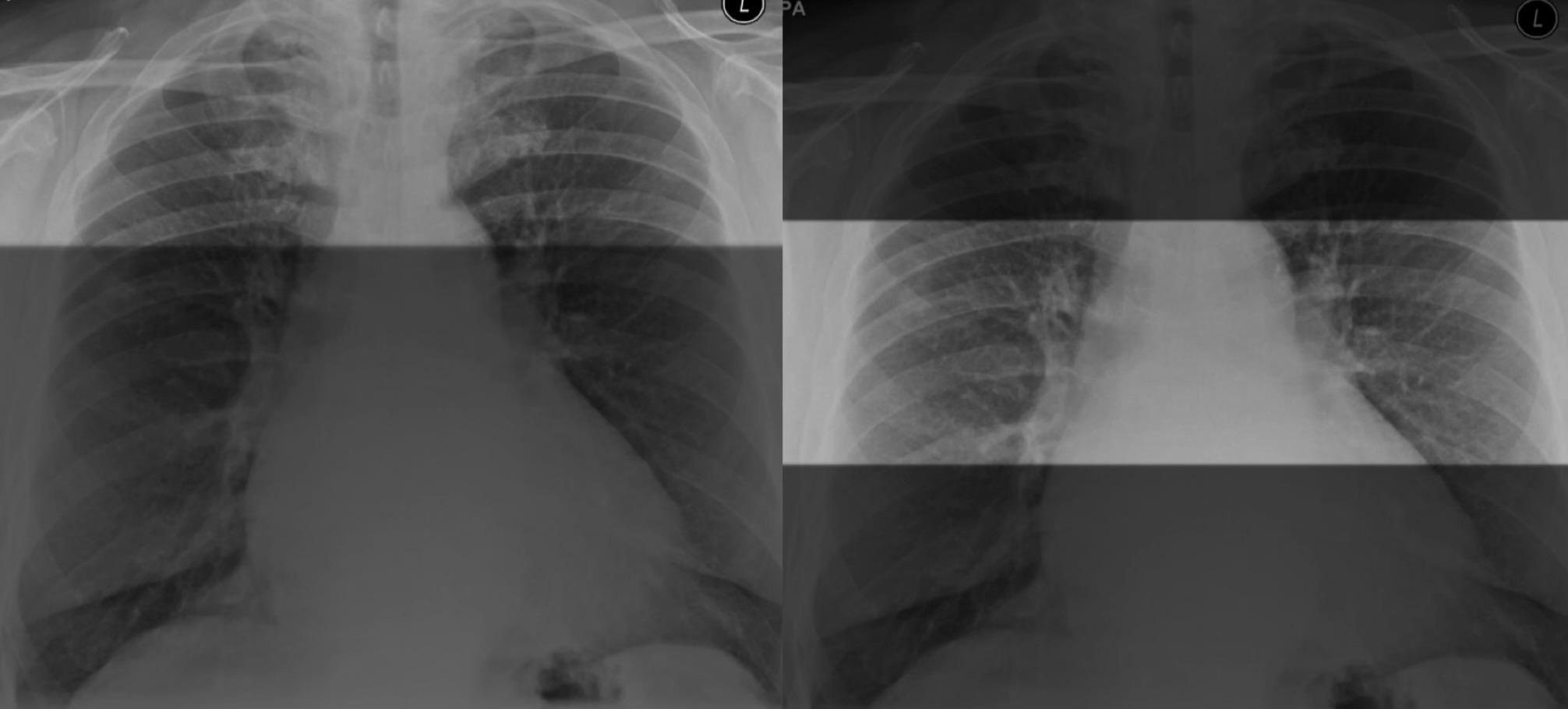 How to Read a Chest X-ray | CXR Interpretation Guide