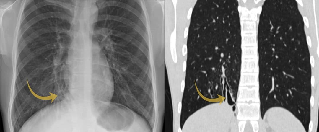Bronchiectasis X-ray Signs | Ring Shadows & Tram Tracks