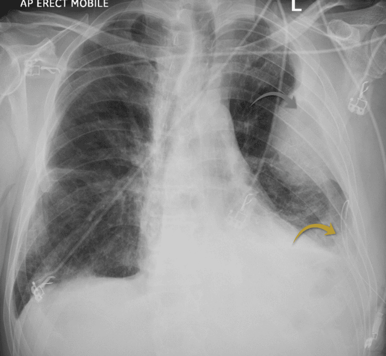 White-out chest X-ray - the Radiologist